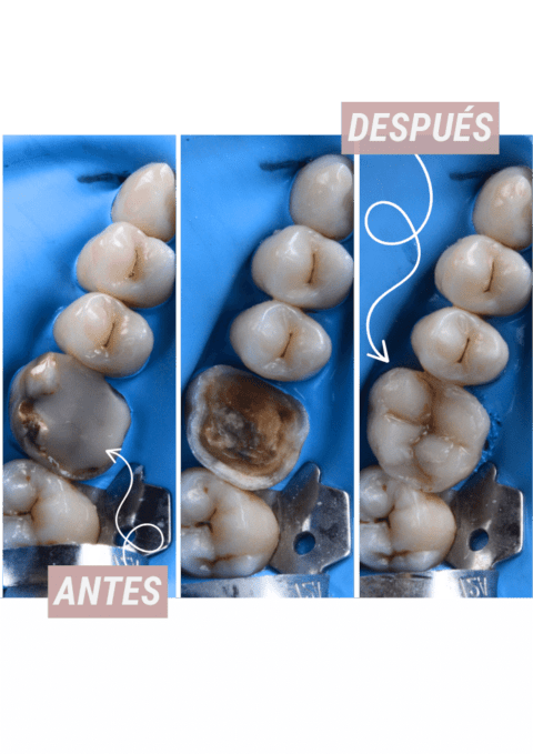 Qué es un Empaste Dental | Planes Mariano Dental ↑