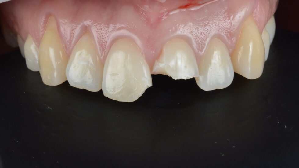 Qué hacer con un diente roto, GUÍA | Planes Mariano Dental ↑