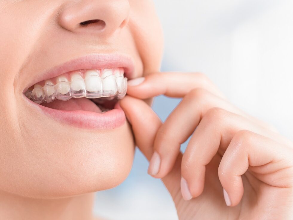 Brackets vs. Invisalign | Planes Mariano Dental ↑